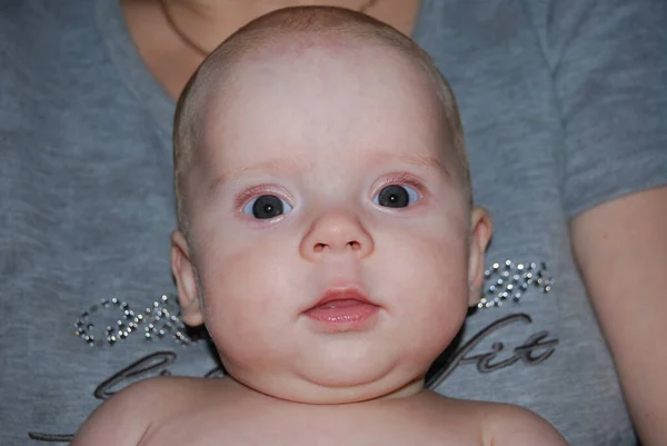 Sindrome De Noonan Bebe Noonan Syndrome Information | Mount Sinai