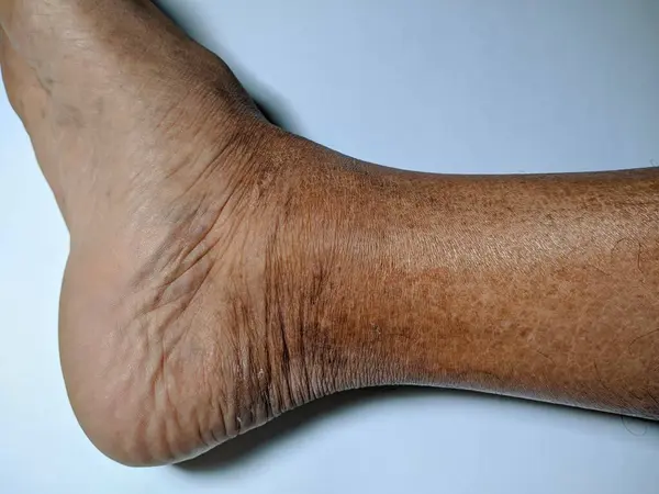 Eschar Stock Photos, Royalty Free Eschar Images | DepositPhotos