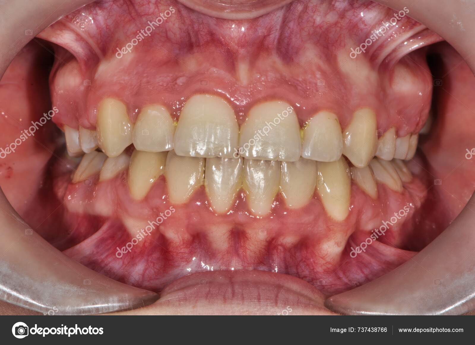 Close Image Adults Teeth Gums Showing Natural Coloration Alignment ...