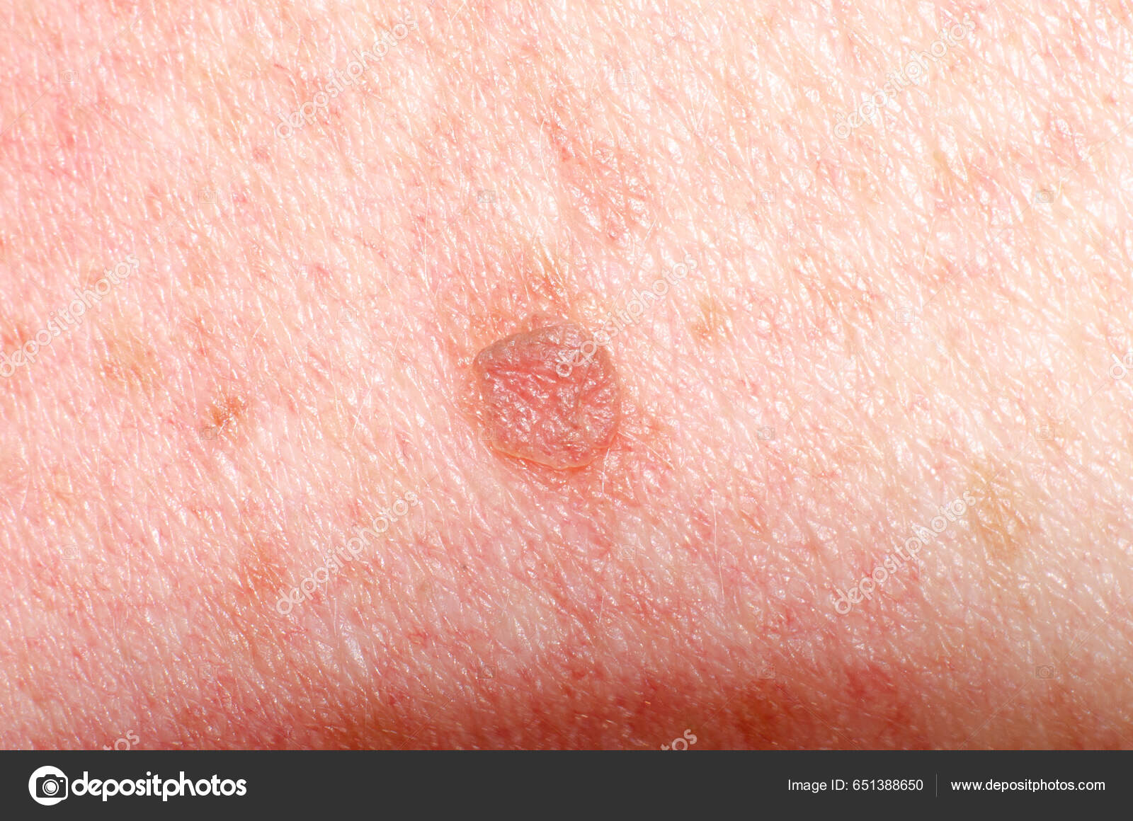 Nevus Papillome Taupe Mélanome Kératose Sur Peau D'un Adulte image ...